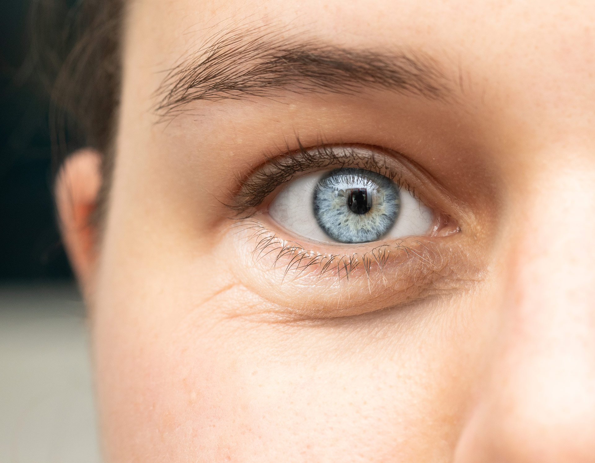 Ojos hinchados, ojeras, enrojecimiento y ardor de ojos